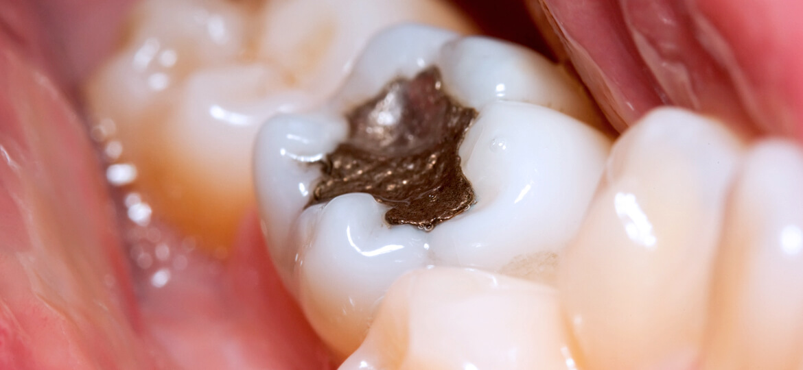 Studio Dentistico FornasieroOtturazioni in amalgama: affidati a chi sa ...